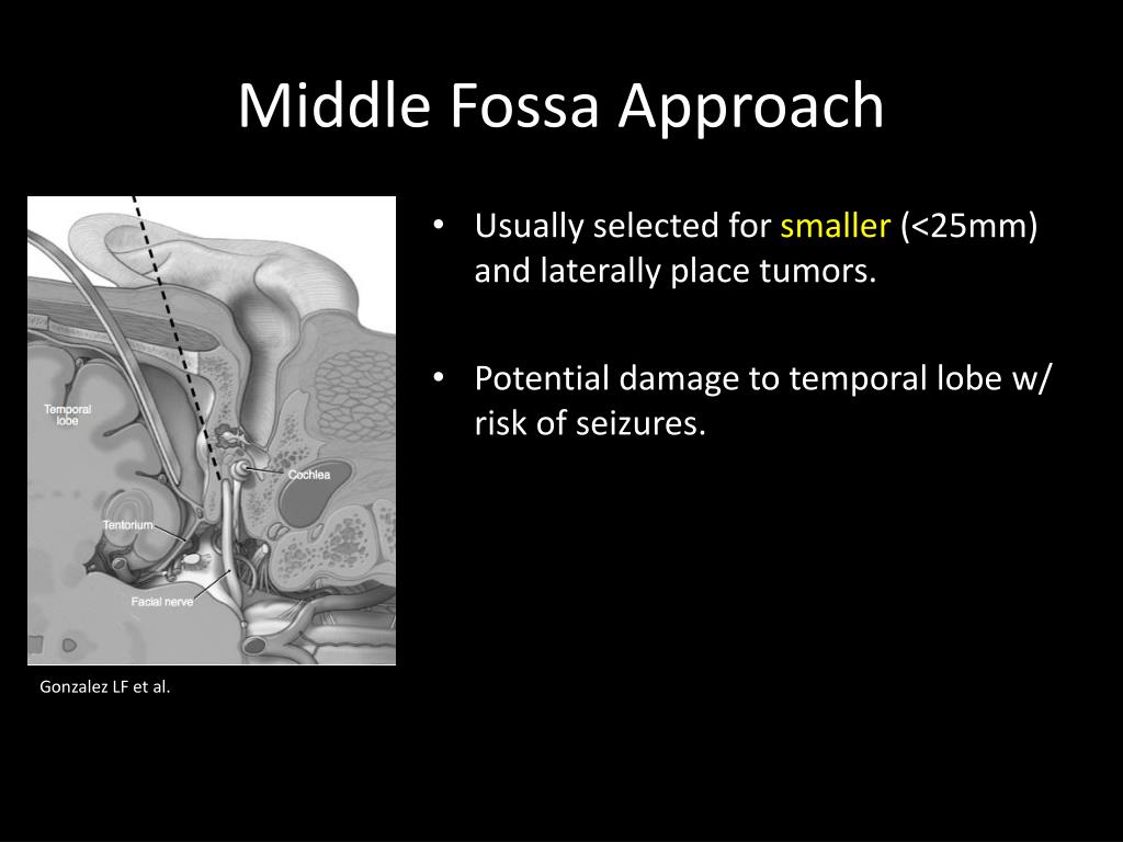 PPT - Vestibular Schwannoma Surgical management and outcomes PowerPoint ...