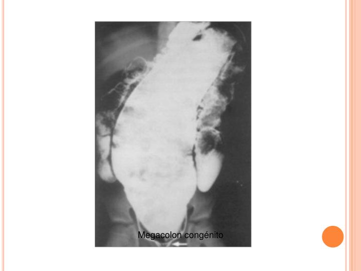 PPT - MEGACOLON PowerPoint Presentation - ID:1997516