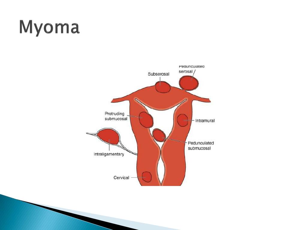 PPT - Tumor jinak ginekologi PowerPoint Presentation, free download ...