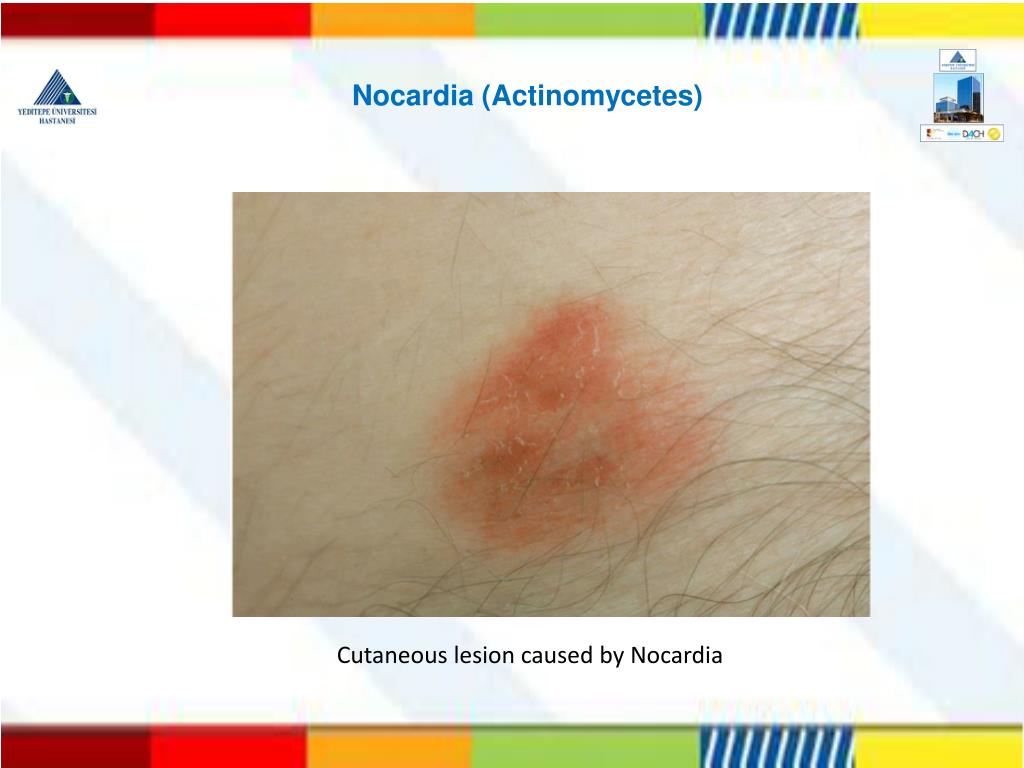 PPT - Nocardia (Aerobic Actinomycetes) PowerPoint Presentation, free ...
