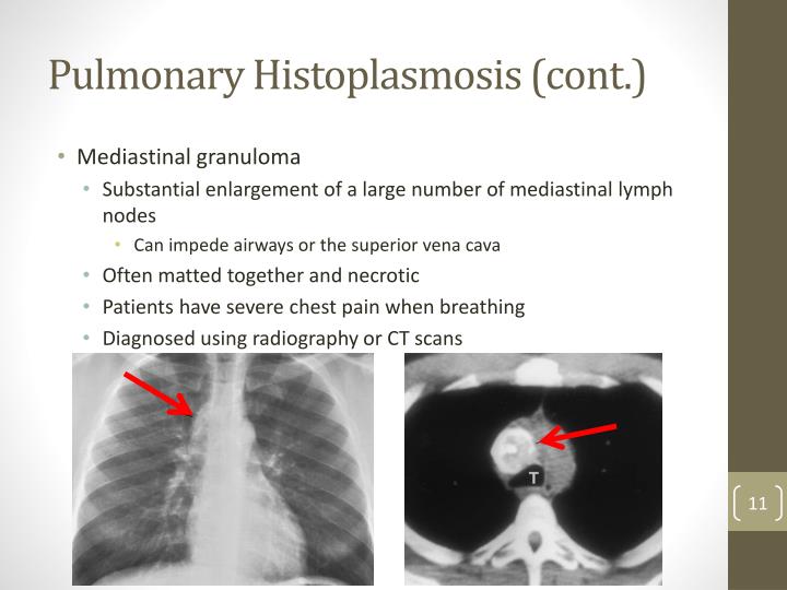 PPT - Histoplasma capsulatum and Histoplasmosis PowerPoint Presentation ...