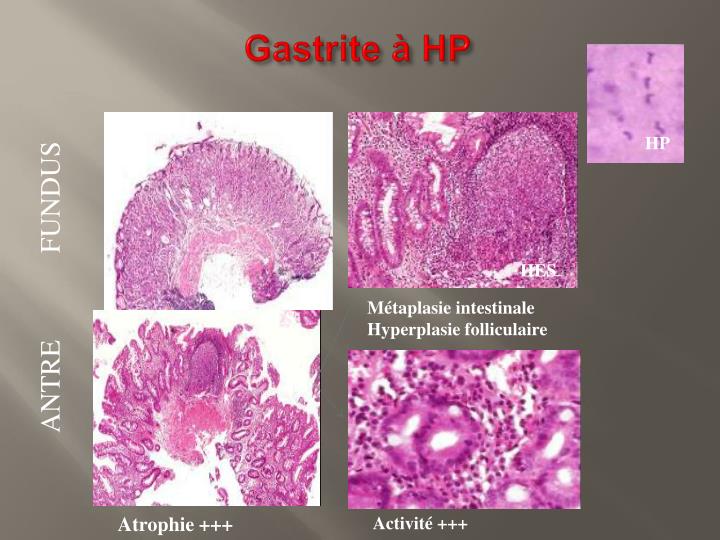 PPT - LES GASTRITES et gastropathies PowerPoint Presentation - ID:2001105