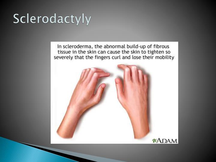 PPT - Systemic Lupus Erythematous and Scleroderma (Crest Syndrome ...