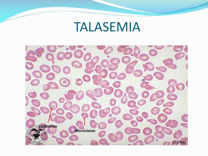 PPT - ANEMIAS PowerPoint Presentation - ID:2005427