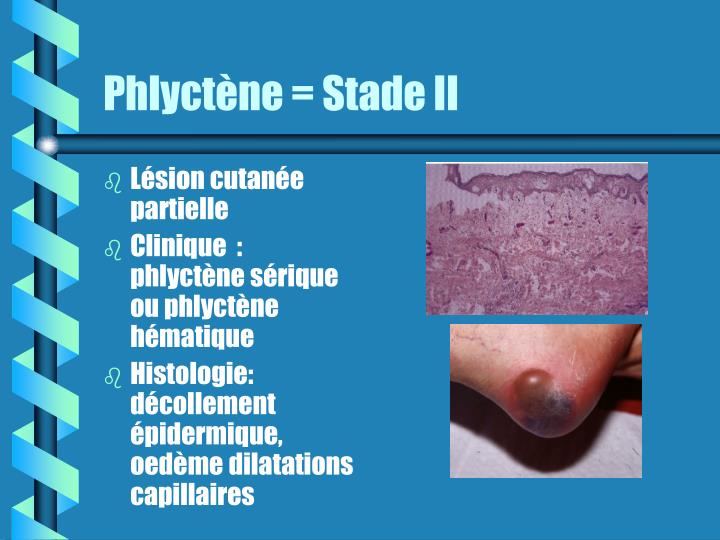 PPT - ESCARRES PHYSIOLOGIE, FACTEURS DE RISQUE ET PRÉVENTION PowerPoint ...