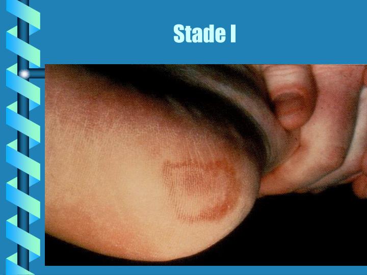 PPT - ESCARRES PHYSIOLOGIE, FACTEURS DE RISQUE ET PRÉVENTION PowerPoint ...