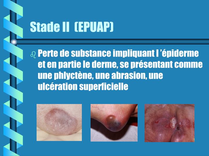 PPT - ESCARRES PHYSIOLOGIE, FACTEURS DE RISQUE ET PRÉVENTION PowerPoint ...