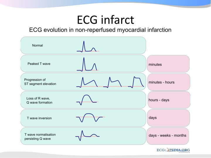 PPT - Dag 3 Ischemie en infarct PowerPoint Presentation - ID:2014869