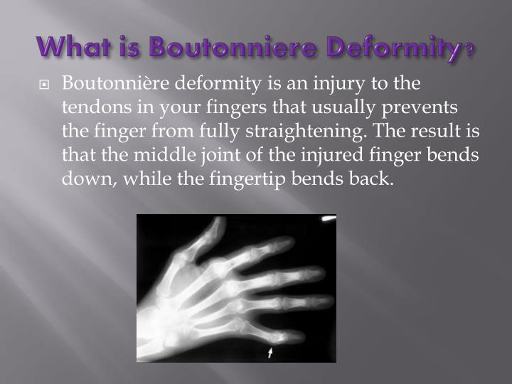 PPT - Boutonniere Deformity PowerPoint Presentation - ID:2016941