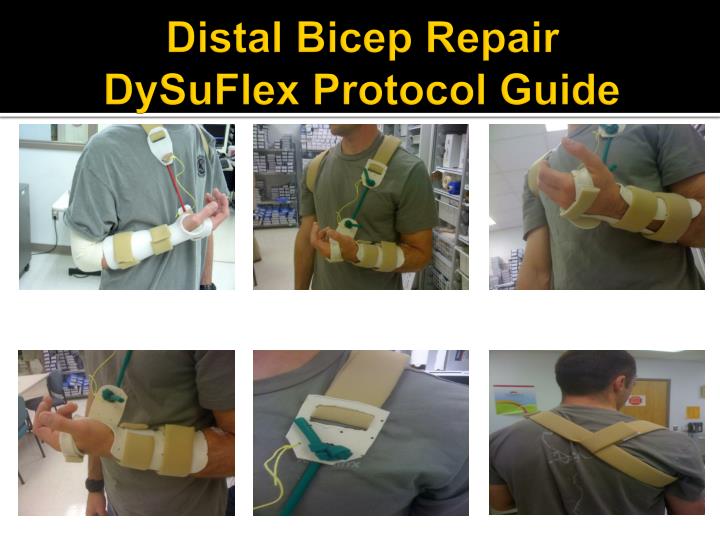 PPT - Distal Bicep Ruptures PowerPoint Presentation - ID:2016984