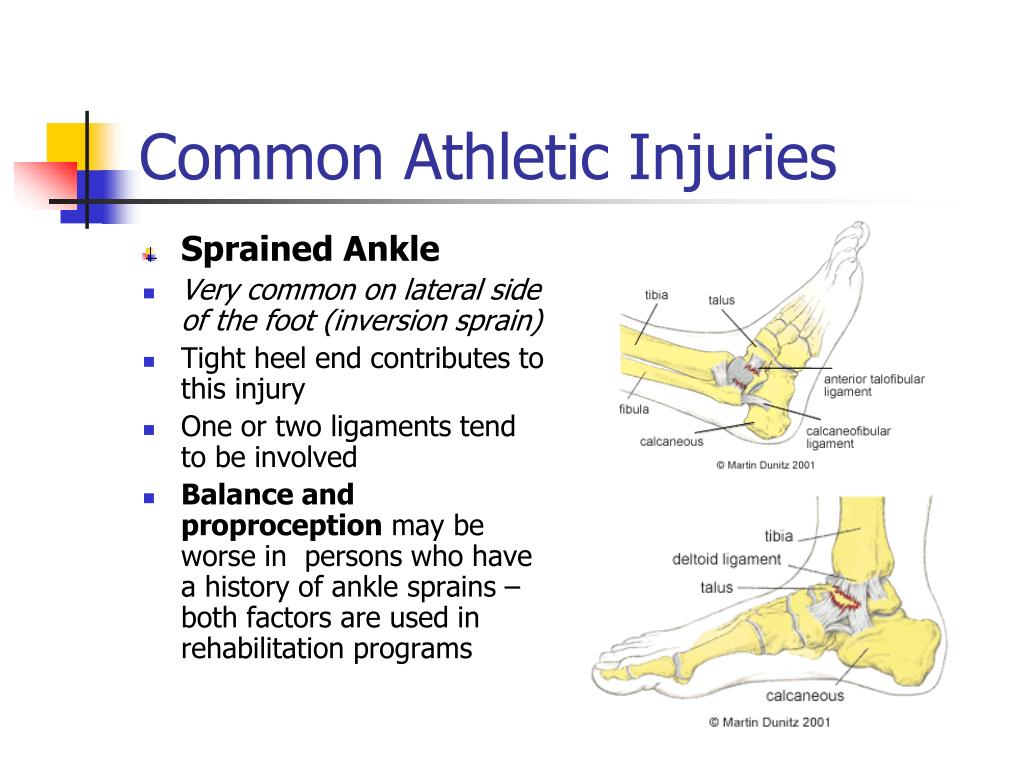 PPT - Care , Prevention and Rehabilitation of Sports Injuries Common ...