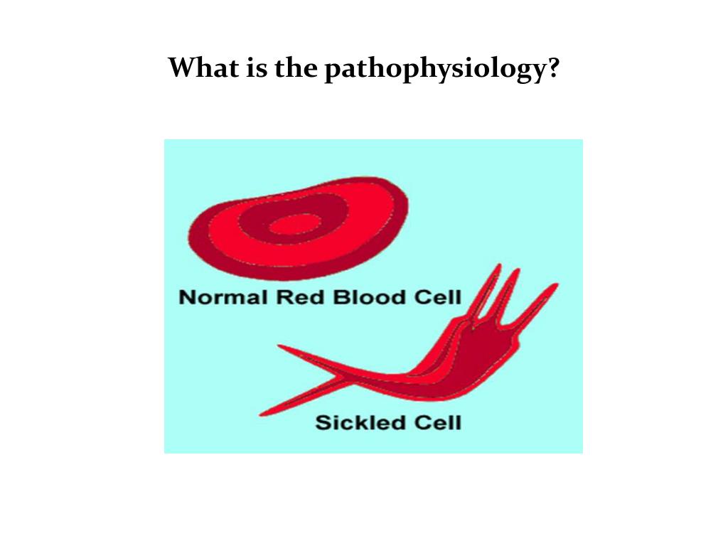 PPT - Sickle Cell Disease Core Concepts for the Emergency P hysician ...