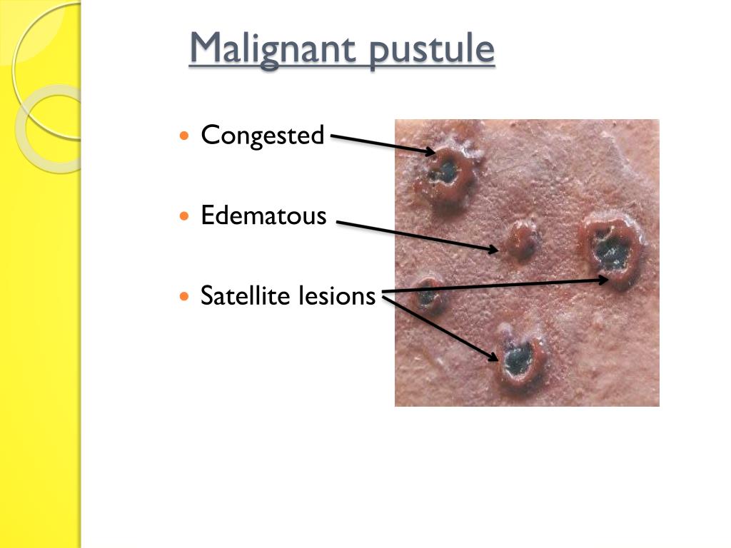 PPT - CLINICAL FEATURES EPIDEMIOLOGY LAB DIAGNOSIS PROPHYLAXIS ...