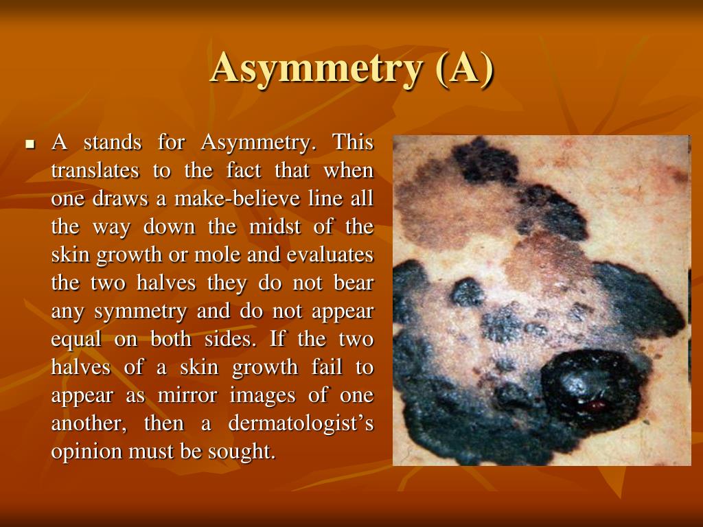 PPT - Being Wary About Five Signs of Skin Cancer PowerPoint ...