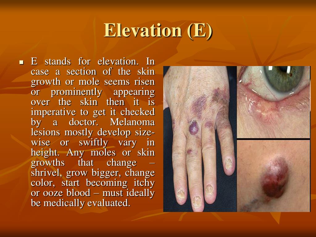 PPT - Being Wary About Five Signs of Skin Cancer PowerPoint ...