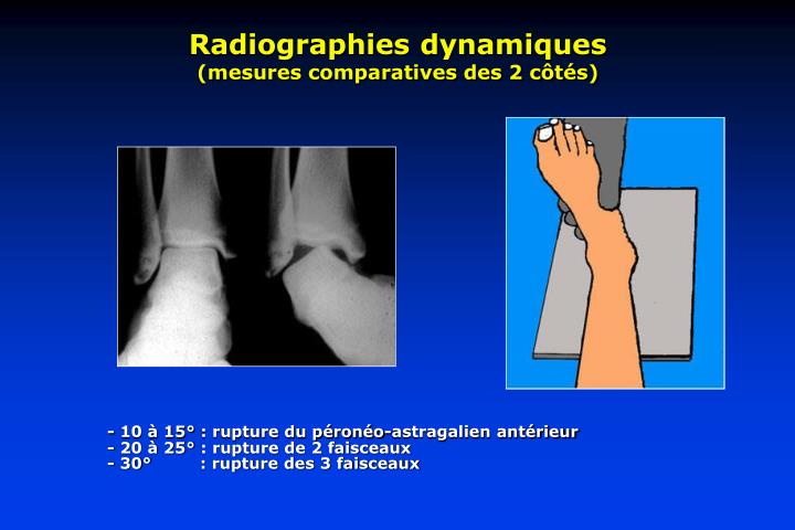 PPT - Traumatologie de la cheville PowerPoint Presentation - ID:2020022