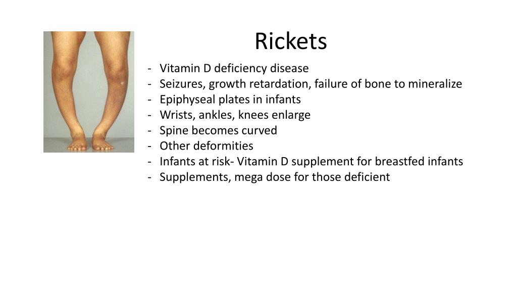 PPT - Calcium & Vitamin D: Osteoporosis, Rickets PowerPoint ...