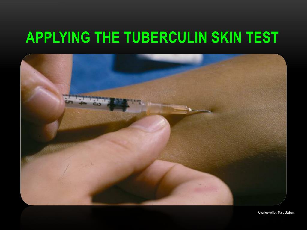 PPT - Tuberculin skin Testing Mantoux tuberculin skin test PowerPoint ...