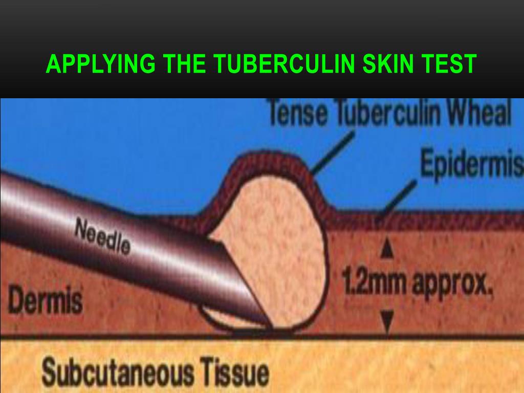 PPT - Tuberculin skin Testing Mantoux tuberculin skin test PowerPoint ... PPT - Tuberculin skin Testing Mantoux tuberculin skin test PowerPoint ...