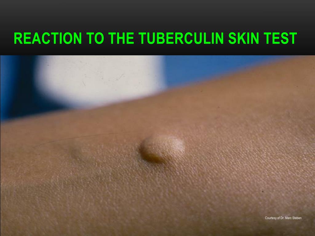Tubercle Skin