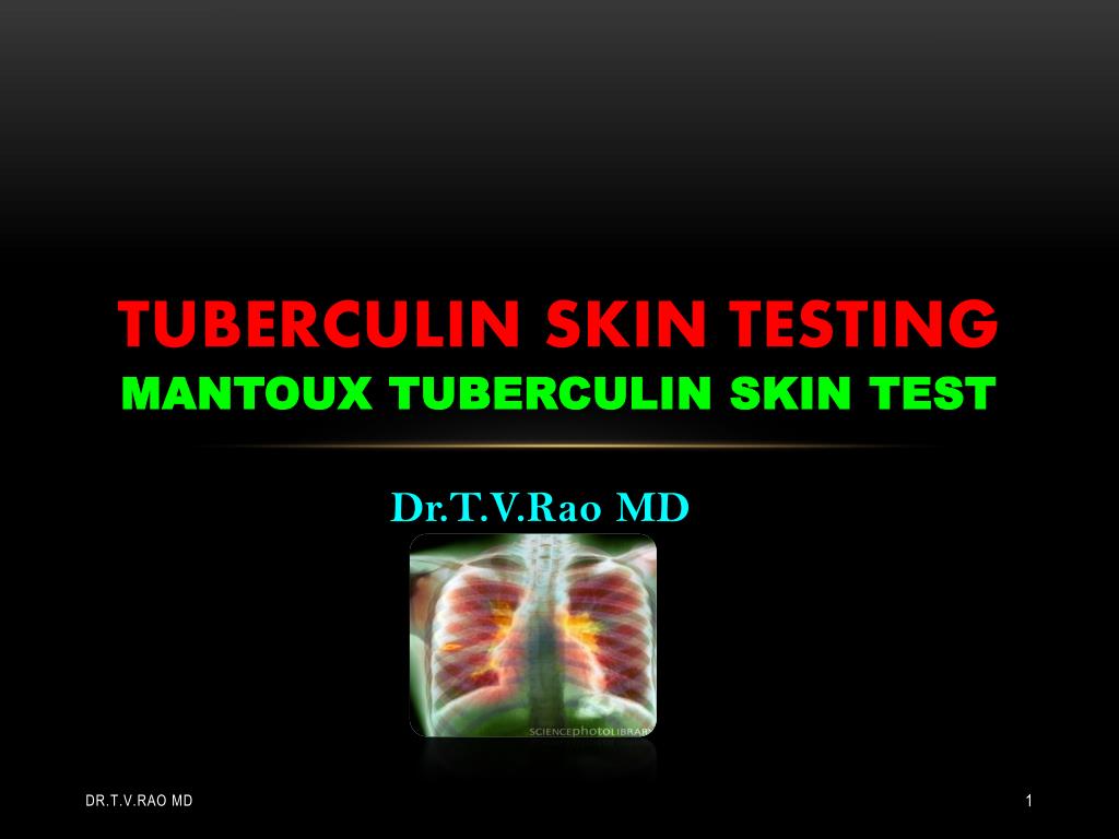 PPT - Tuberculin skin Testing Mantoux tuberculin skin test PowerPoint ...