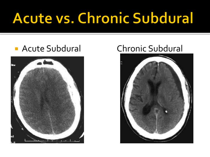 Chronic Subdural Hematoma Vs Acute Subdural Hematoma: Background,