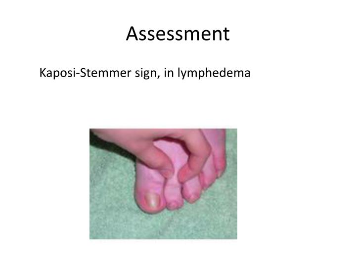 PPT - Edema PowerPoint Presentation - ID:2026887