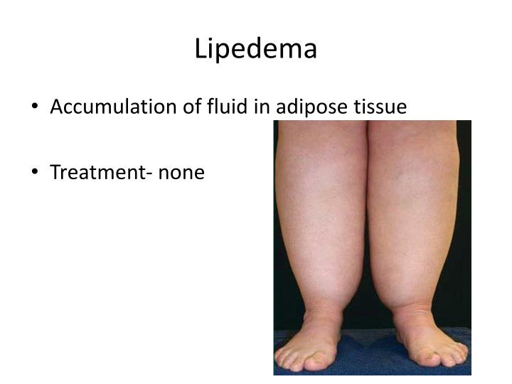 PPT - Edema PowerPoint Presentation - ID:2026887