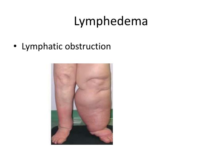 PPT - Edema PowerPoint Presentation - ID:2026887