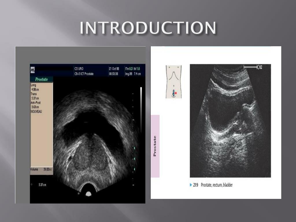 PPT - ECHOGRAPHIE TRANSRECTALE ET PATHOLOGIE BENIGNE DU CARREFOUR ...
