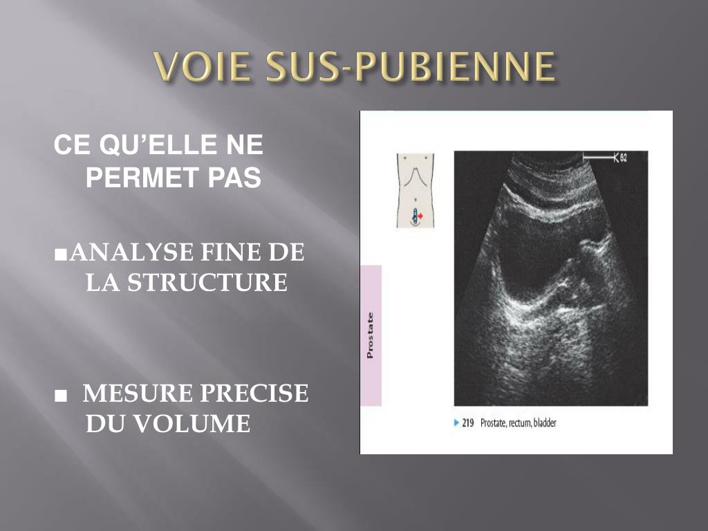PPT - ECHOGRAPHIE TRANSRECTALE ET PATHOLOGIE BENIGNE DU CARREFOUR ...