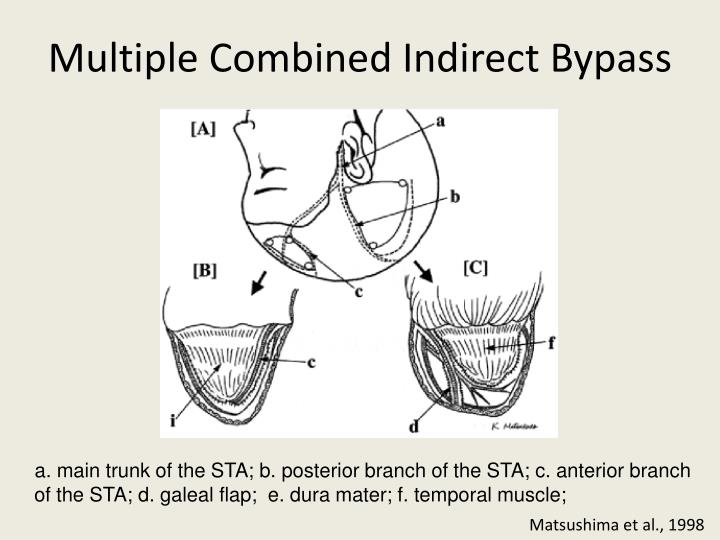 PPT - Comparison of Direct and Indirect Bypass for Moyamoya Disease ...