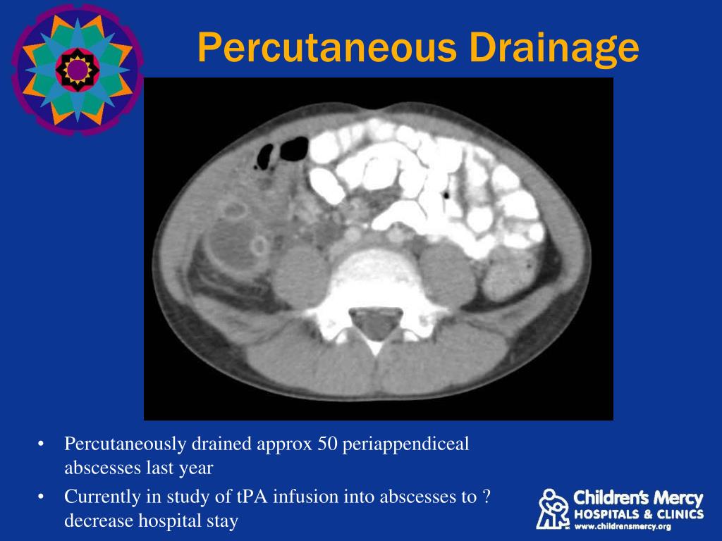 PPT - State of the Art Pediatric Interventional Radiology Brent Cully ...