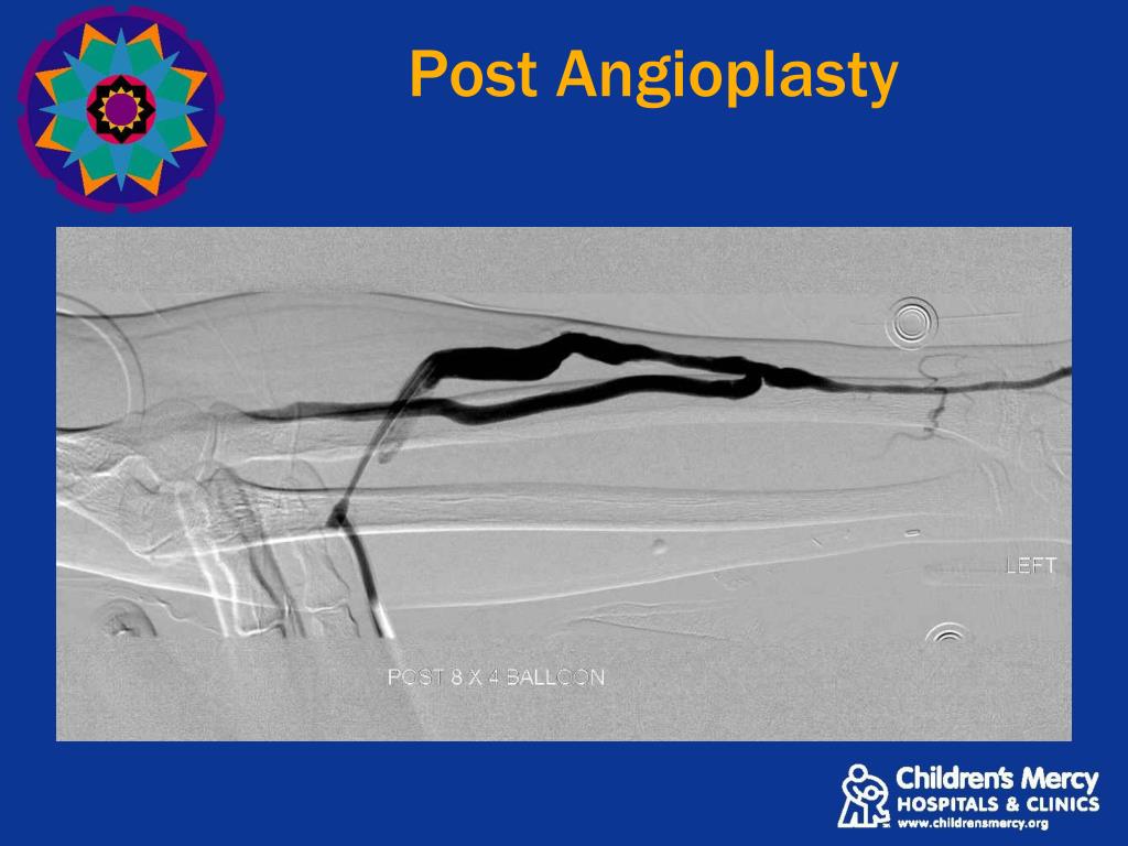 PPT - State of the Art Pediatric Interventional Radiology Brent Cully ...