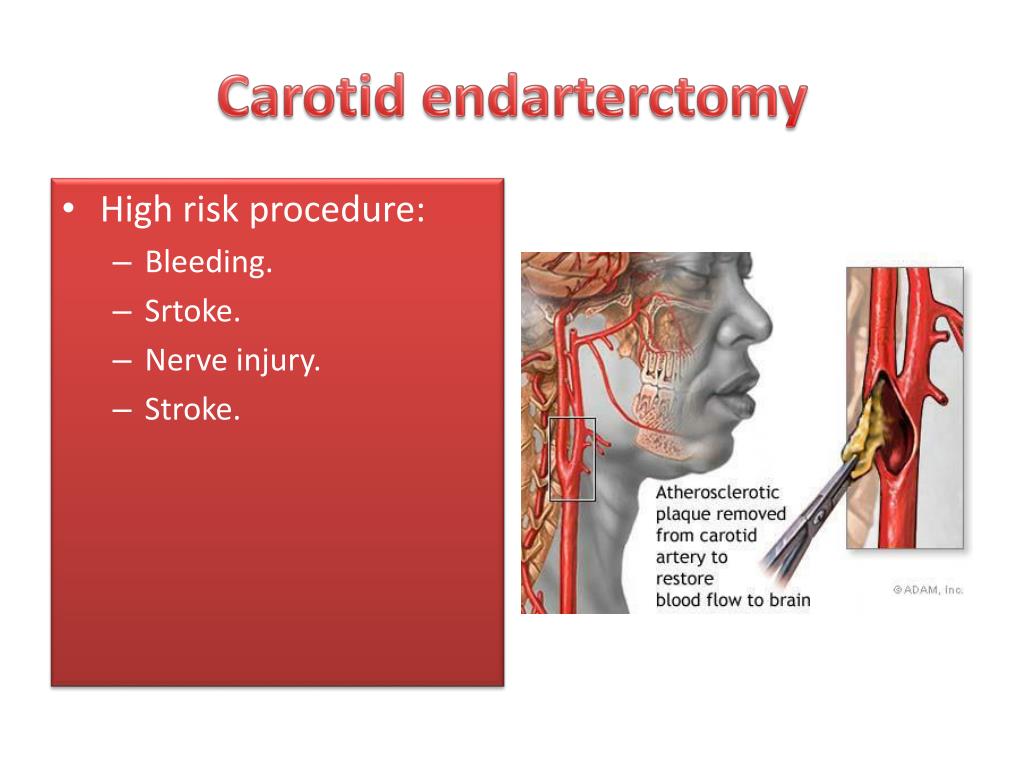 PPT - Carotid artery disease PowerPoint Presentation, free download ...