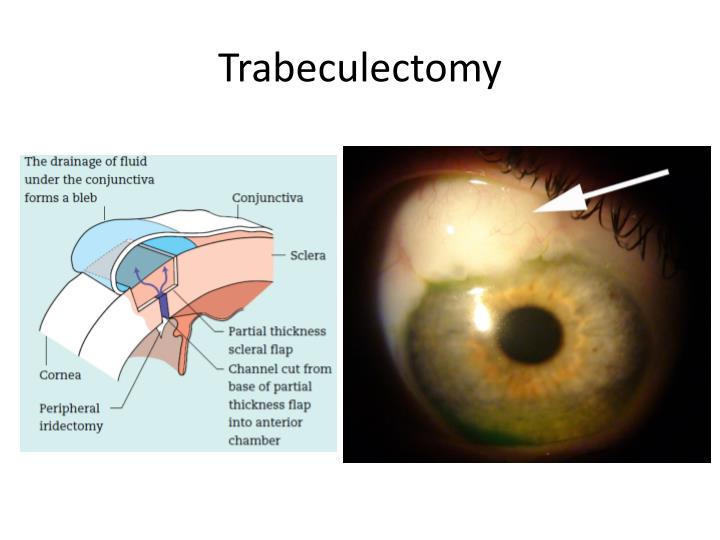PPT - Glaucoma PowerPoint Presentation - ID:2028894