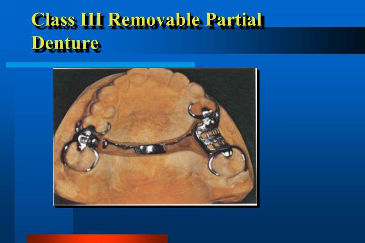 PPT - Principles of RPD Design PowerPoint Presentation - ID:2029079