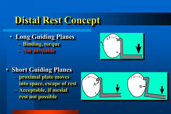 PPT - Principles of RPD Design PowerPoint Presentation - ID:2029079