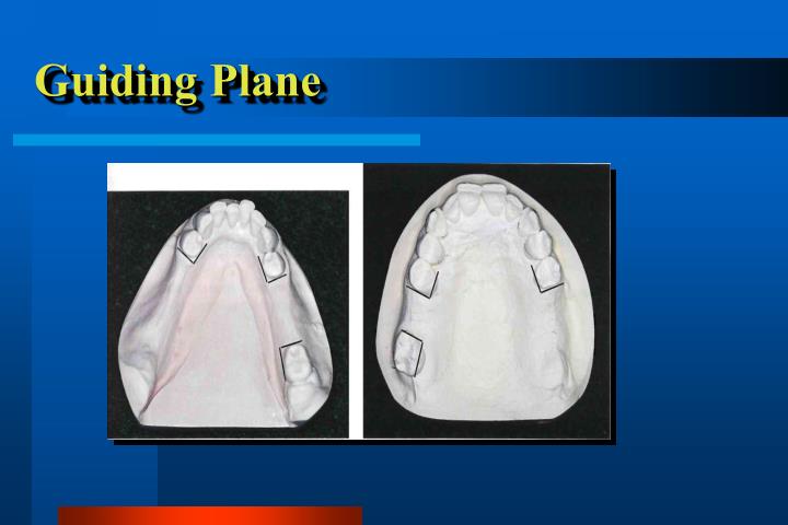 PPT - Principles of RPD Design PowerPoint Presentation - ID:2029079