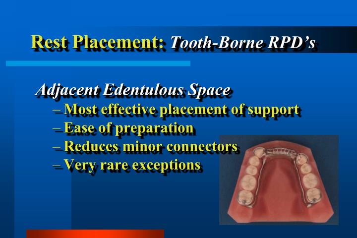 PPT - Principles of RPD Design PowerPoint Presentation - ID:2029079