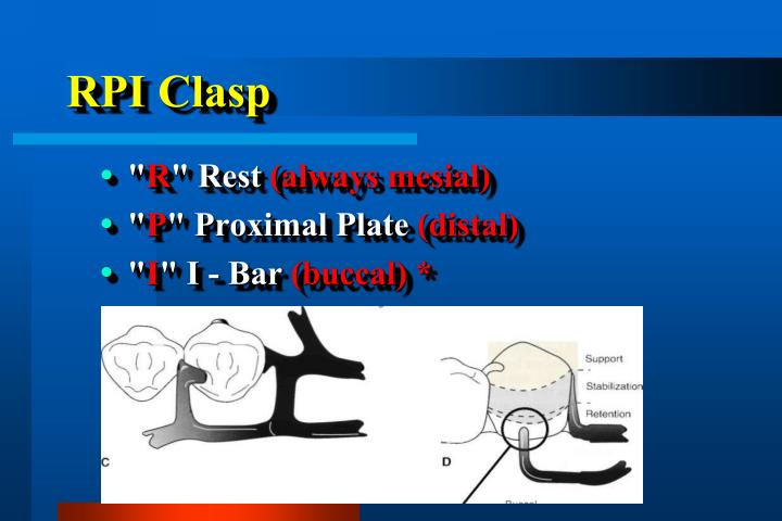 PPT - Principles of RPD Design PowerPoint Presentation - ID:2029079