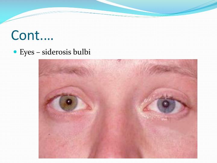 PPT - SIDEROSIS PowerPoint Presentation - ID:2029132