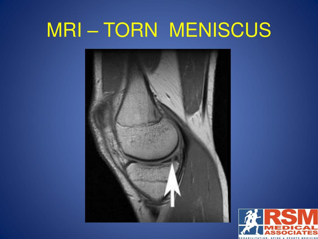 PPT - KNEE INJURIES IN SPORTS MEDICINE PowerPoint Presentation, free ...