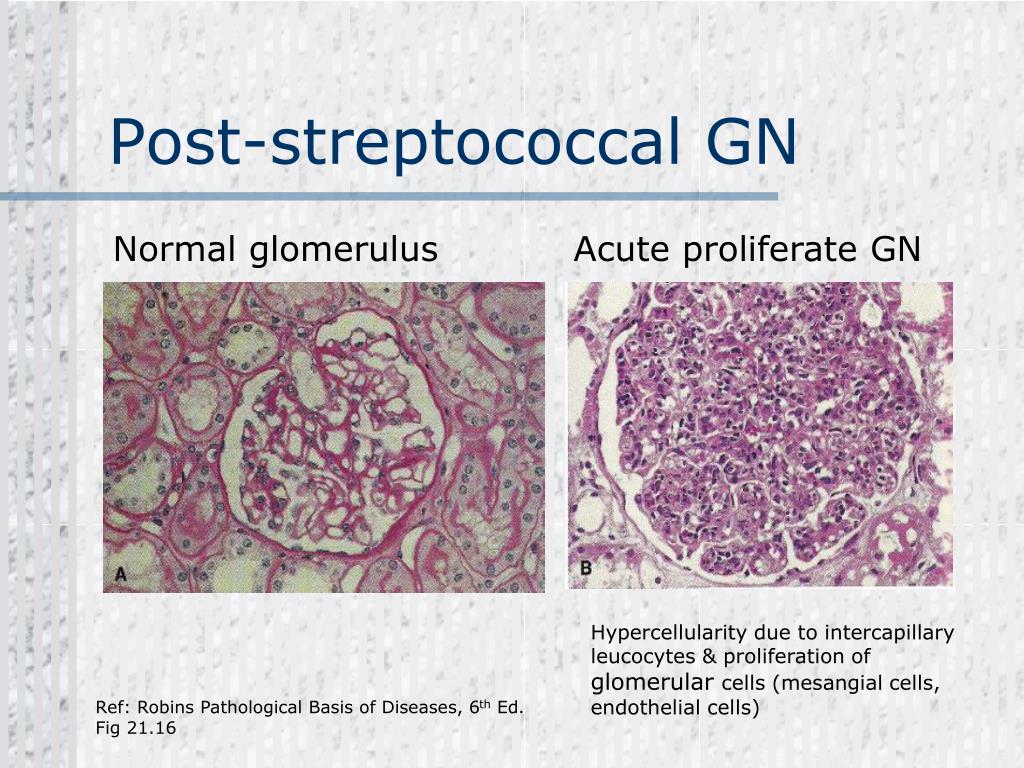 PPT Glomerulonephritis PowerPoint Presentation Free Download ID