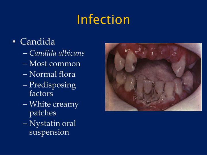 PPT - Ulcers of the oral Cavity PowerPoint Presentation - ID:2034889