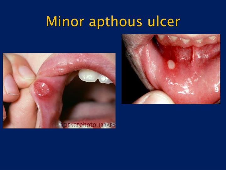 PPT - Ulcers of the oral Cavity PowerPoint Presentation - ID:2034889