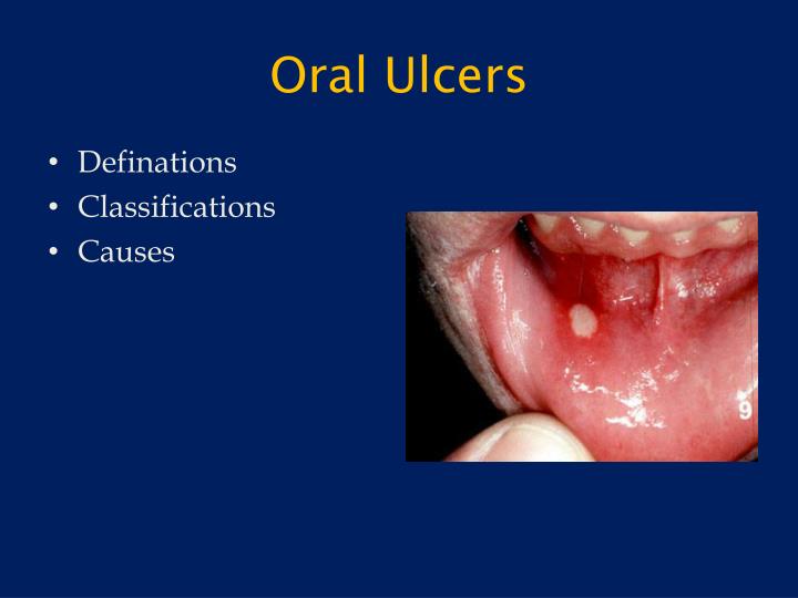 PPT - Ulcers of the oral Cavity PowerPoint Presentation - ID:2034889