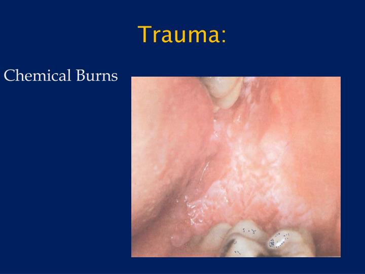 PPT - Ulcers of the oral Cavity PowerPoint Presentation - ID:2034889