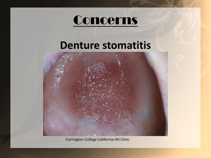 PPT - Denture Stomatitis PowerPoint Presentation - ID:2034905