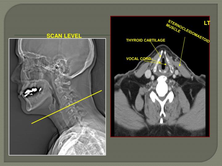 PPT - CT NECK PowerPoint Presentation - ID:2036160
